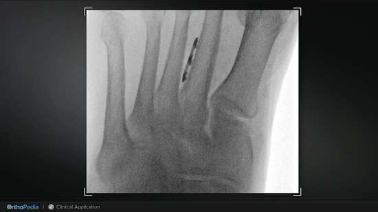 Hallux Valgus: Adjunct Fixation With the Knotless Mini TightRope ...