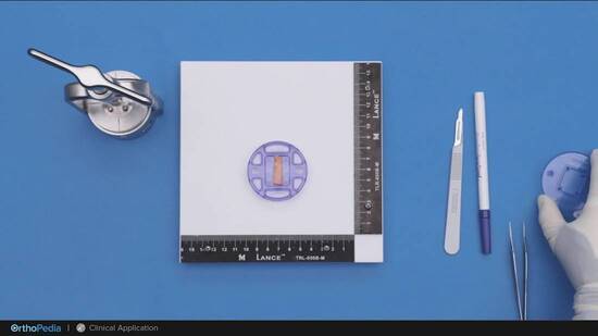 Posterosuperior Rotator Cuff Tears: Graft Preparation for Auto CuffMend ...