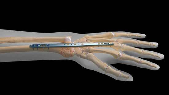Wrist Fractures: Management With Spanning Wrist Plating Animation ...