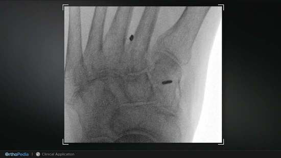 Lisfranc Injuries: Knotless Fixation Using the Mini TightRope® Implant ...