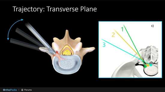 Spine Evolutions: Transforaminal Endoscopic Approach : OrthoPedia