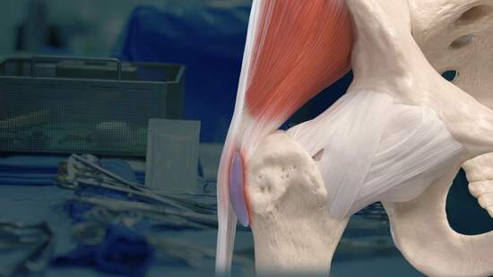 Hip Bursitis: Treatment Options : OrthoPedia Patient