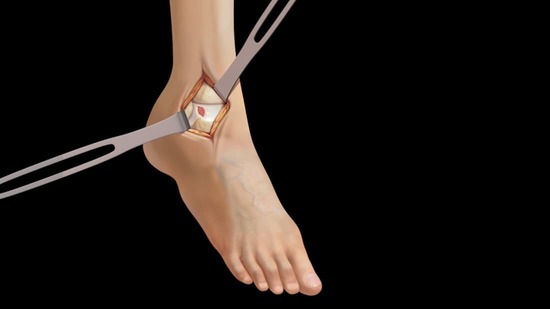 Talus Cartilage Injuries: Treatment Options : OrthoPedia Patient