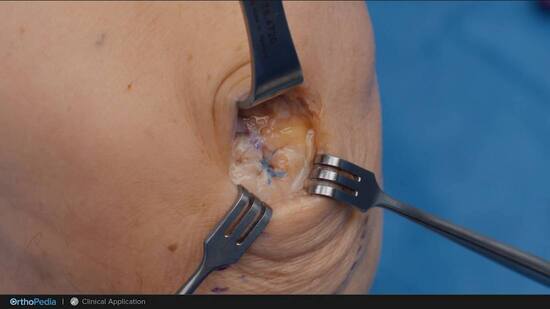 Anterior Cruciate Ligament (ACL) Injuries: FiberLink™ QuadClose ...