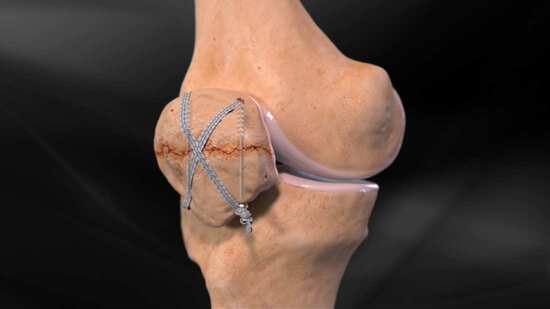 Kneecap Fractures (Patella Fractures): Fixation With Screws and Braided ...