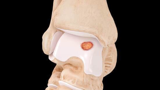 Talus Cartilage Injuries : OrthoPedia Patient