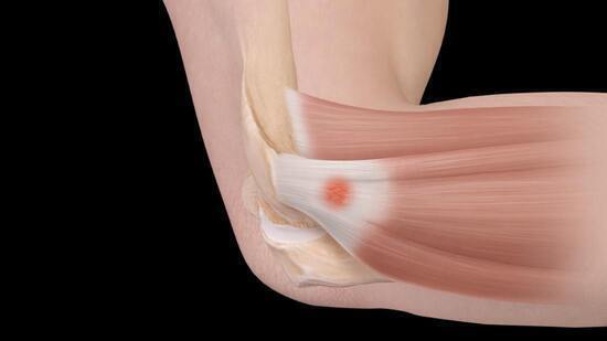Tennis Elbow (Lateral Epicondylitis) : OrthoPedia Patient