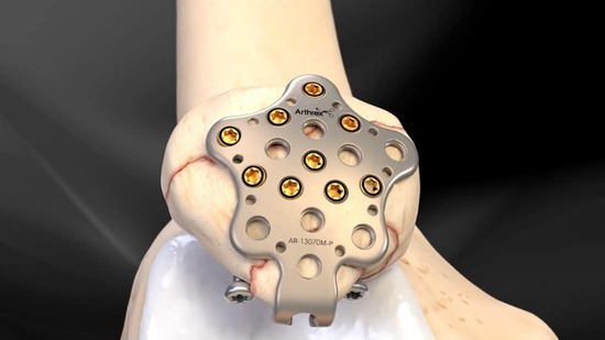 Kneecap Fractures (Patella Fractures): Fixation With a Plate and Screws ...