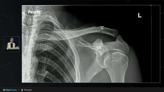 Knotless AC TightRope® Technique for Acromioclavicular Joint Injuries ...