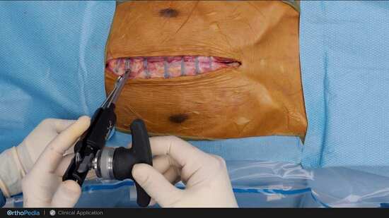 Median Sternotomy Closure: Overlapping Figure-of-8 Technique Using ...
