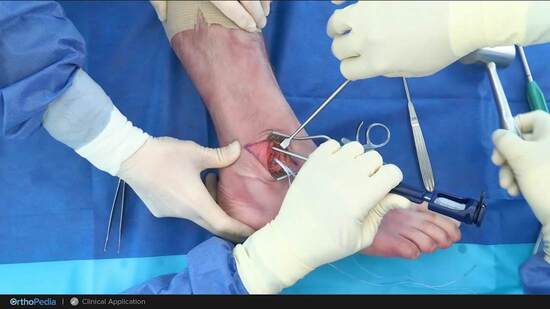 Lateral Ankle Instability: InternalBrace™ Technique for Brostrom Repair ...