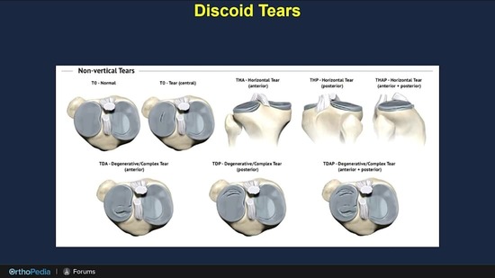 Overview of Discoid Meniscus : OrthoPedia