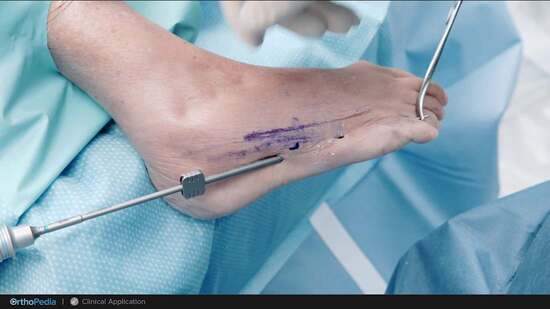 Lesser Toe Pathologies: Minimally Invasive Correction of a Type 3 Tailor’s Bunion Using a ...