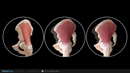 Peritrochanteric Hip Pathologies: General Surgical Considerations ...