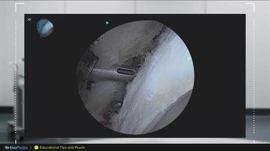 Dr. Menge Demonstrates Tips and Pearls for Hip Labral Tears: Anchor ...