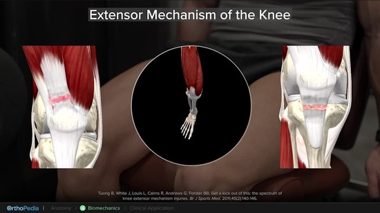 Biomechanics of the Knee With Extensor Mechanism Injuries : OrthoPedia