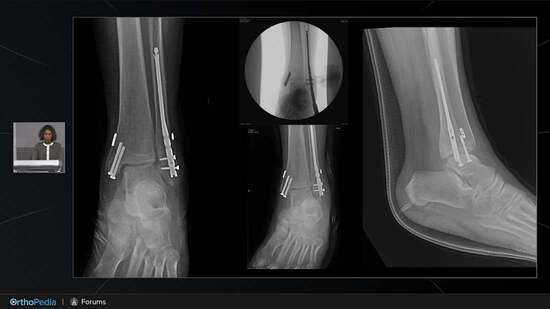 Fibular Intramedullary Nail Fixation in Ankle Fractures : OrthoPedia