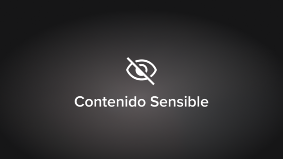 Fracturas de Clavícula: Reducción Abierta y Fijación Interna con Placa ...