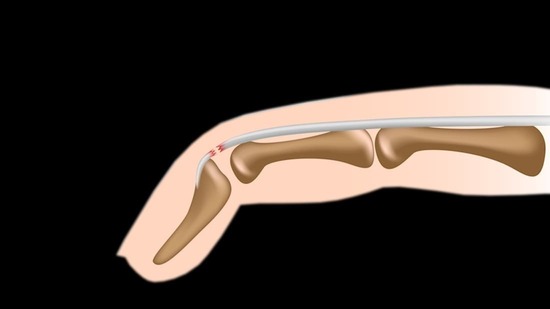 Dedo en Mazo: Visión General : OrthoPedia Patient