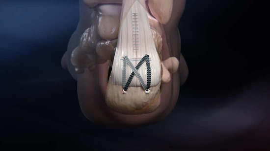 Tendinitis de Aquiles: Animación sobre la Resección del Espolón Óseo y ...