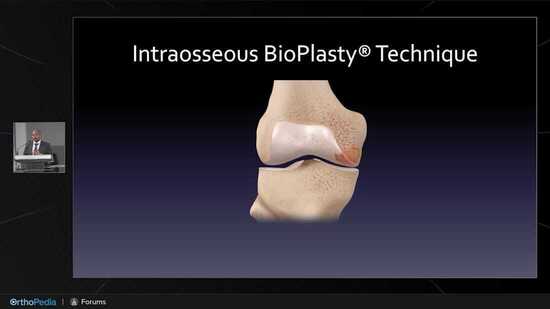 Treating Bone Marrow Lesions: IntraOssesous BioPlasty® (IOBP ...