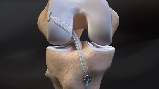 Anterior Cruciate Ligament (ACL) Tears: ACL Reconstruction Using an All ...