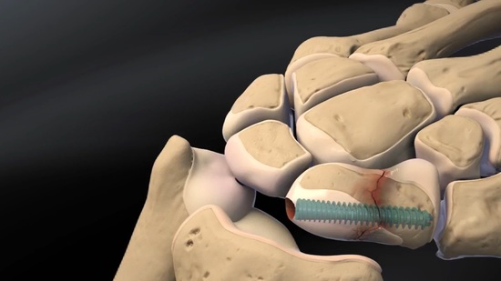 Scaphoid Fractures of the Wrist: Fixation With a Screw Animation ...