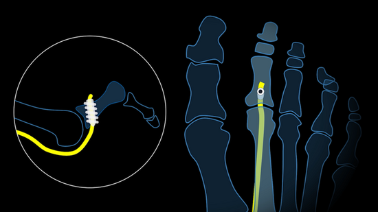 Small Toe Deformities: Treatment Options : OrthoPedia Patient