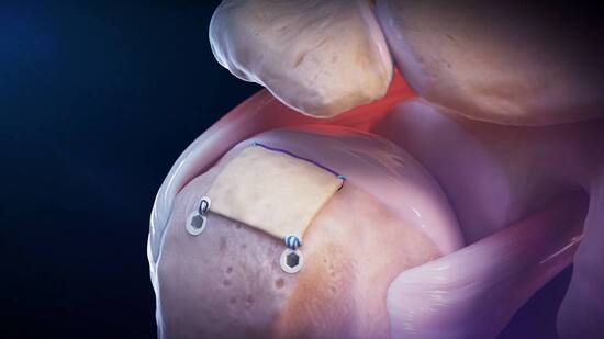 Rotator Cuff Tears: Biologic Tuberoplasty With a Biologic Skin Graft as ...