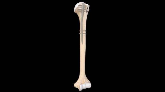 Upper Arm Bone Fractures (Proximal Humerus Fractures): Fixation With a ...
