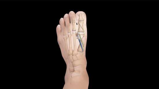Bunions: MIS Surgery Bunion Correction Animation : OrthoPedia Patient