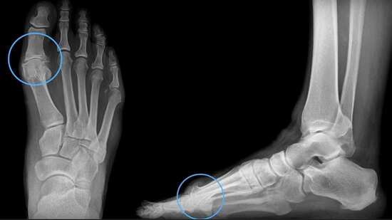 Big Toe Arthritis: Treatment Options : OrthoPedia Patient