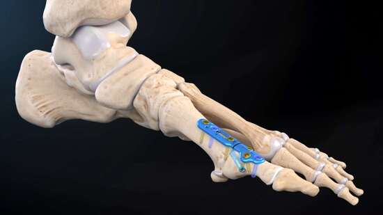 Big Toe Arthritis: Great Toe Joint Fusion With a Plate and Screws ...