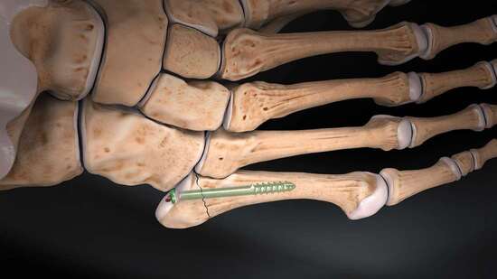 Outer Foot Bone Fractures (5th Metatarsal Fractures): Screw Fixation ...