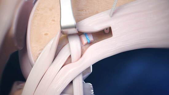 Anterior Cruciate Ligament (ACL) Tears: Lateral Extra-Articular ...