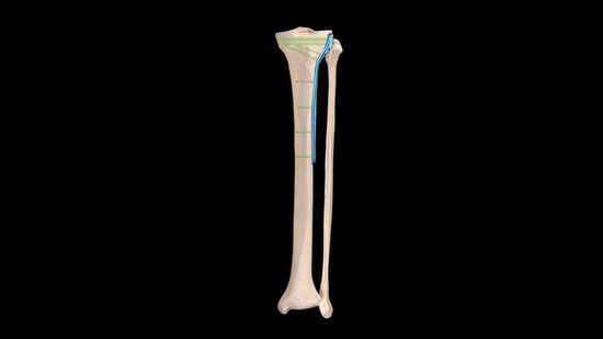 Upper Shinbone Fractures (Tibial Plateau Fractures): Fixation With a ...