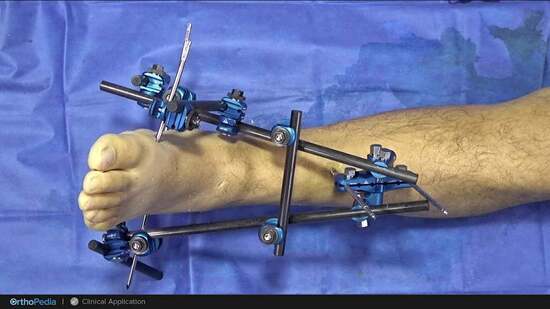 Pilon (Distal Tibia) Fractures: Delta Frame With the ArthroFX® External ...